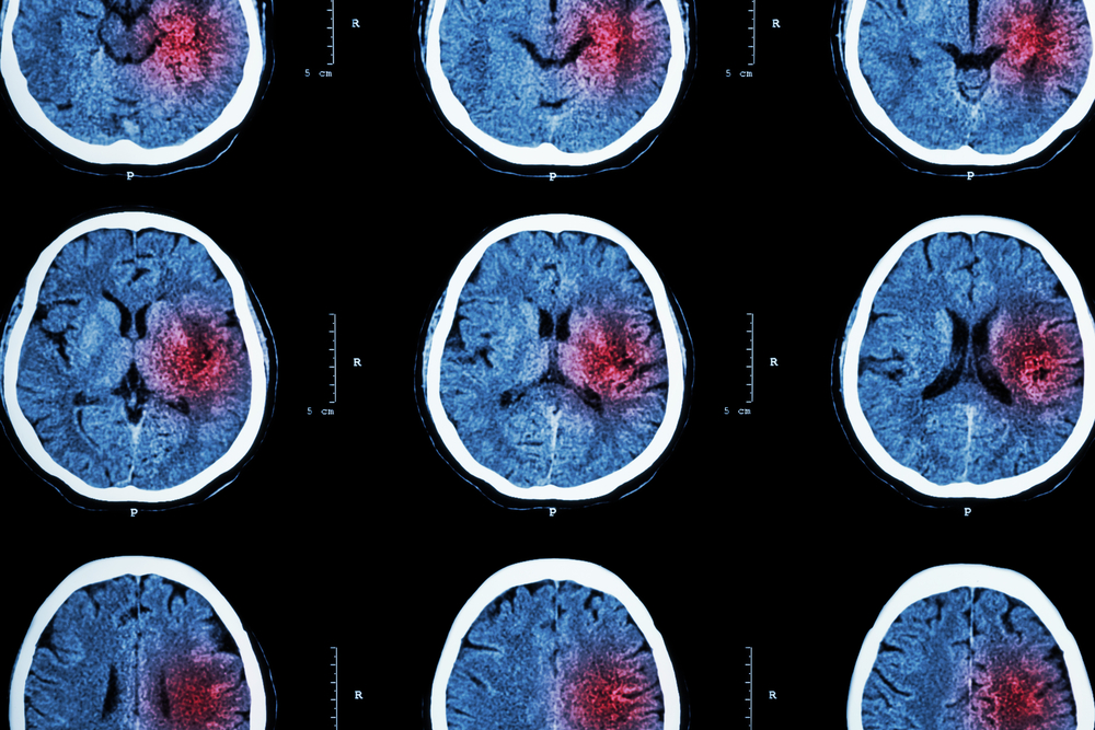 10 Major Risk Factors for Stroke Can Be Modified, Researchers Say